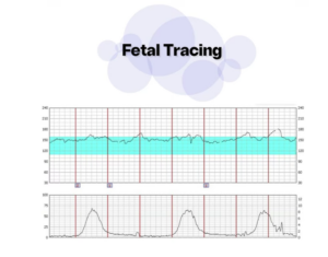 Everything You Need to Know About Fetal Monitoring - MamasteFit