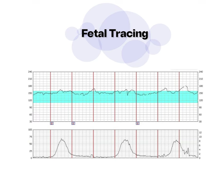 Everything You Need to Know About Fetal Monitoring - MamasteFit