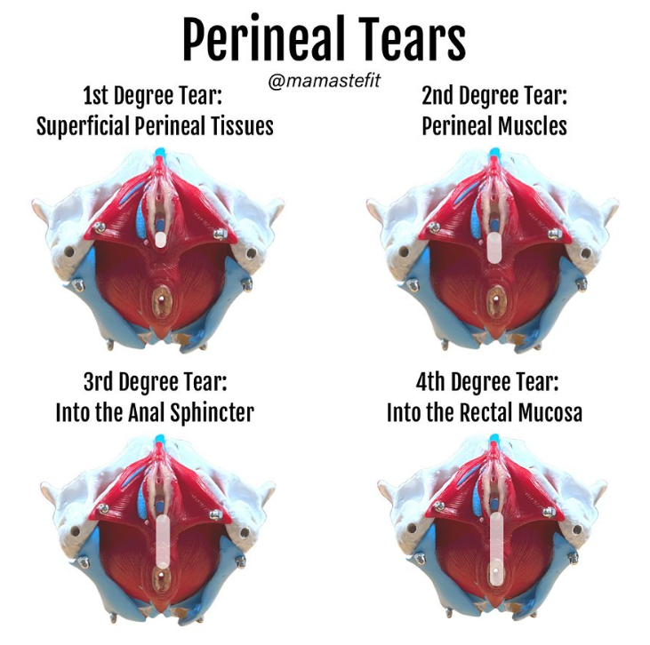 What Does a Vaginal Tear Look Like? Types & Healing - MamasteFit